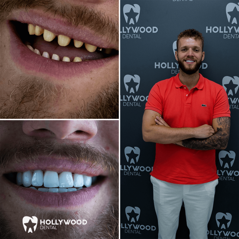 Smile Makeover in Turkey with Affordable Prices