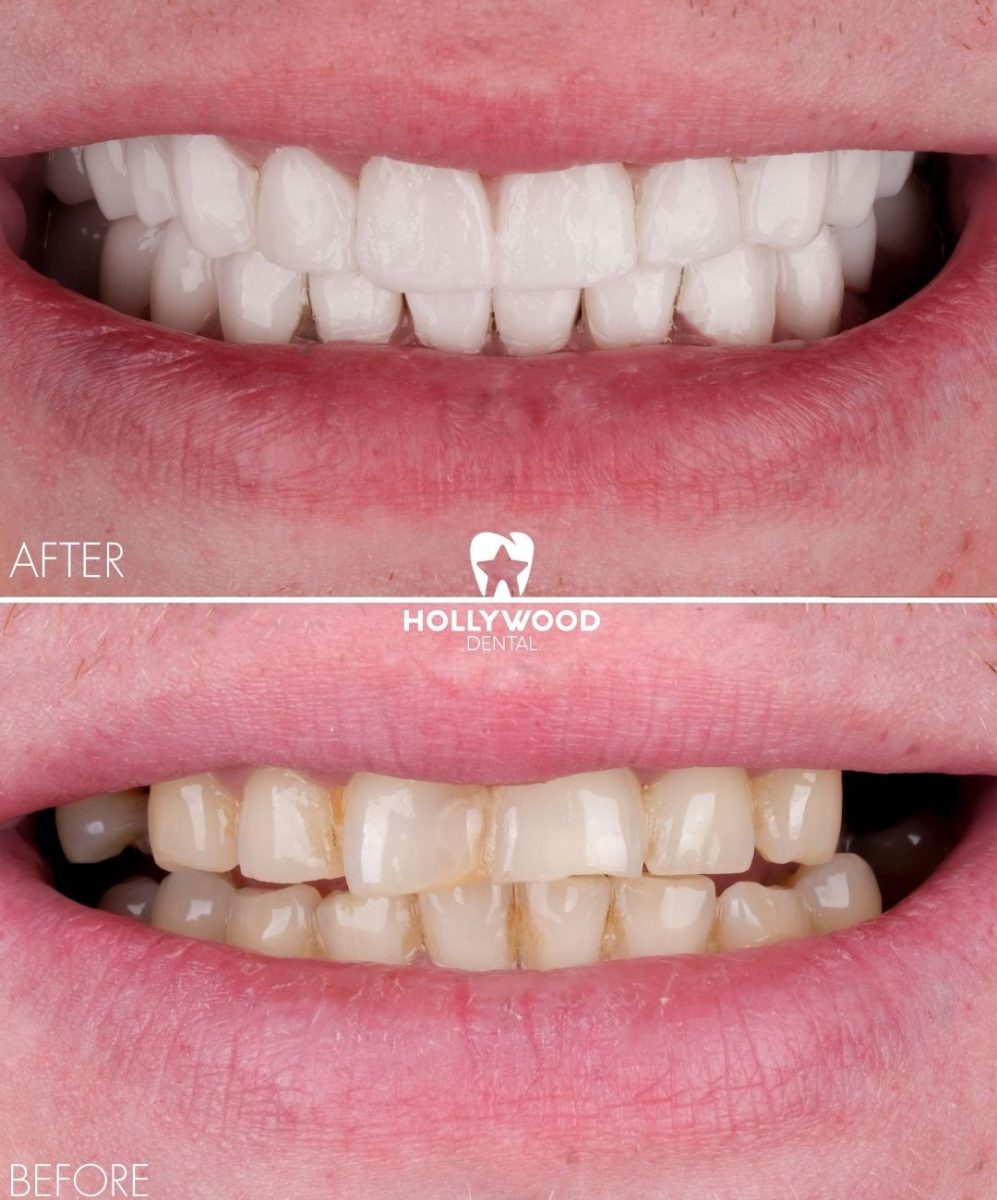Smile Makeover in Turkey with Affordable Prices