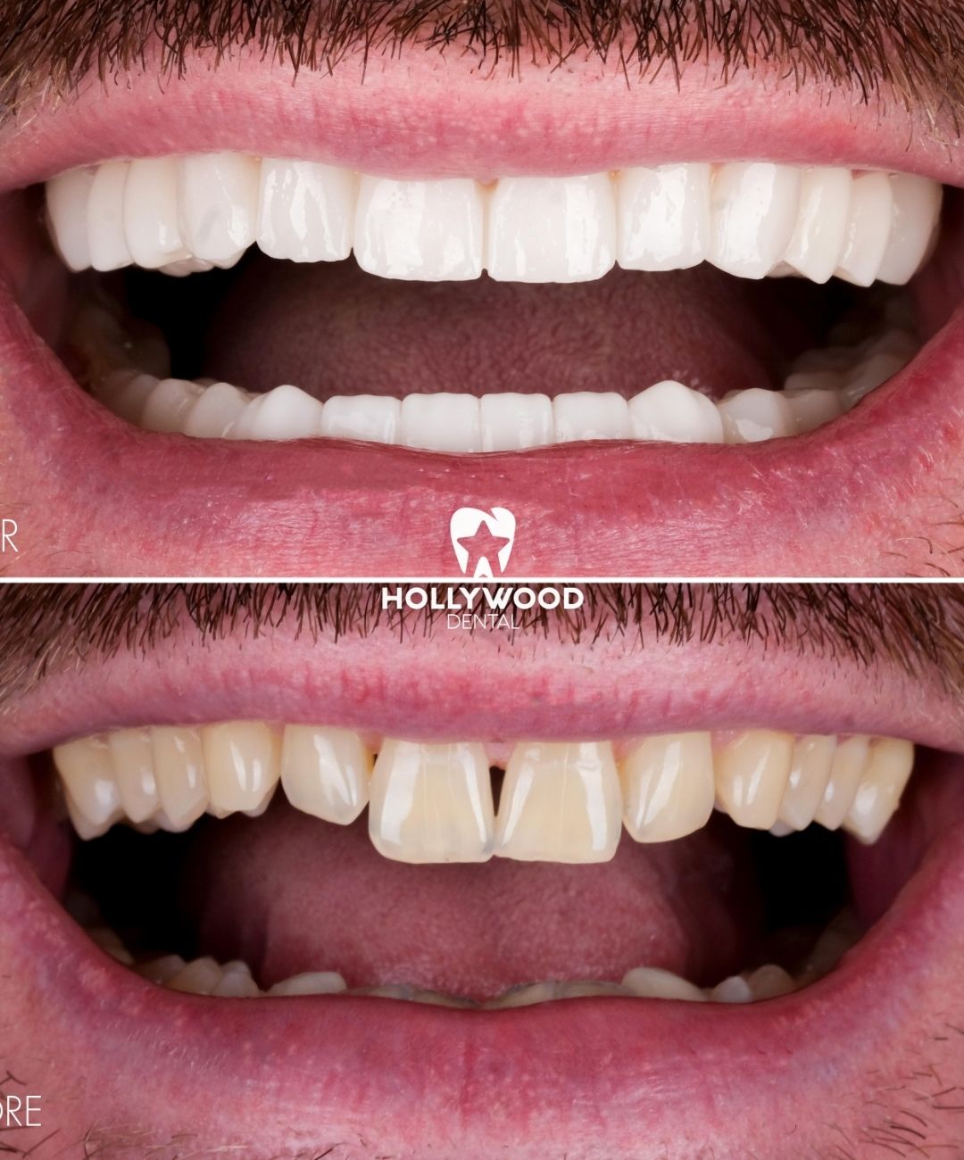 Dental Veneers in Turkey - Porcelain, E-Max, Zirconium