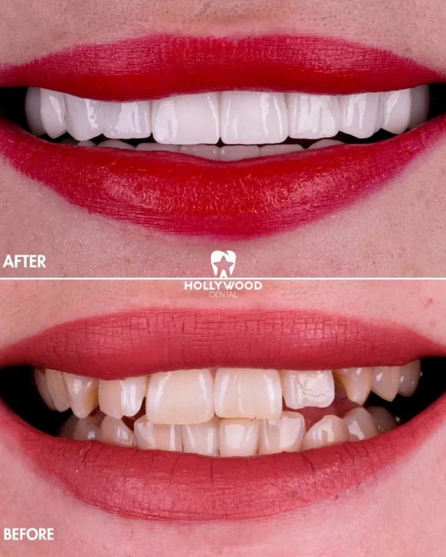 Dental Veneers in Turkey - Porcelain, E-Max, Zirconium